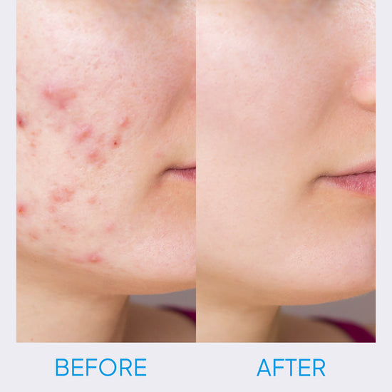 K-Pharmacy Viral Bestseller Bundle for Acne (Ecrin Gel 20g + Acnon Cre ...